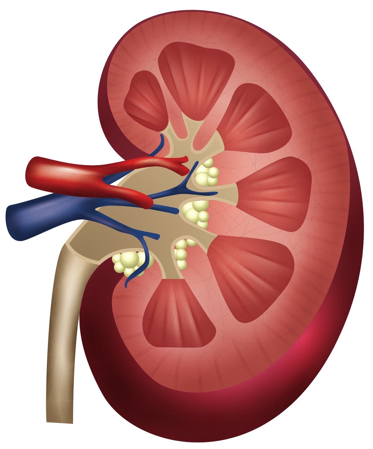 Cálculo renal: causas, sintomas e tratamento - Suridata